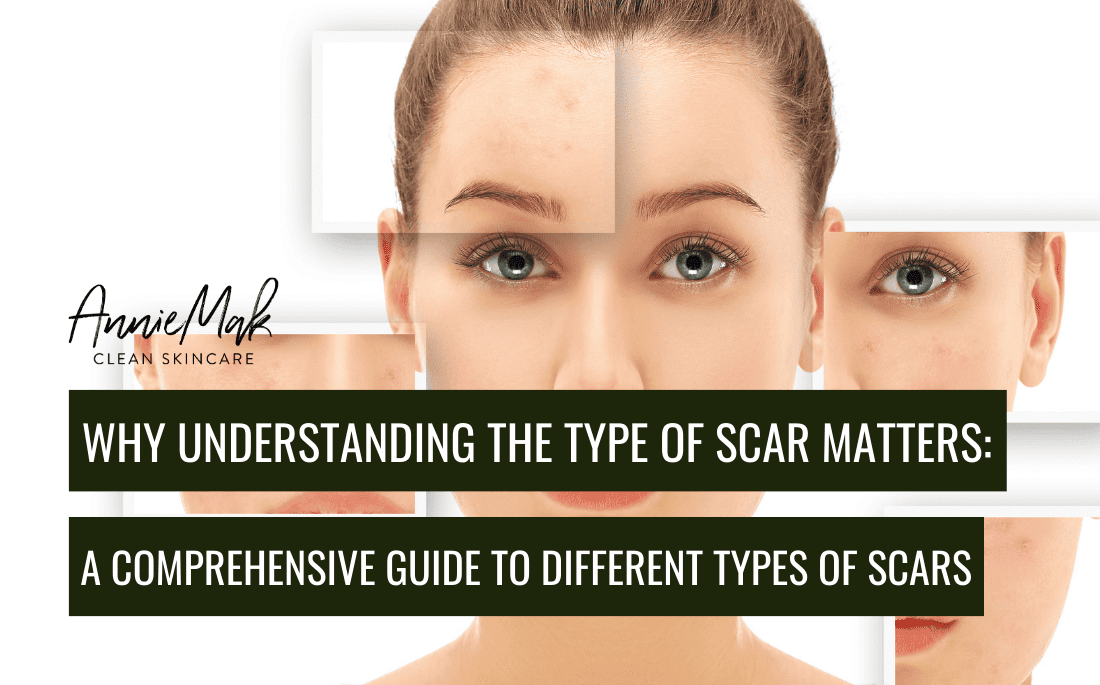 Why Understanding Your Type of Scar Matters ~ AnnieMak Blog Why Understanding Your Type of Scar Matters ~ AnnieMak Blog