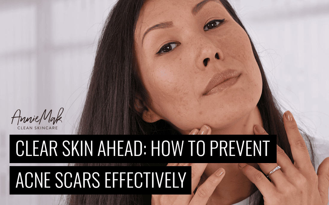 Clear Skin Ahead: How to Prevent Acne Scars Effectively ~ AnnieMak Blog